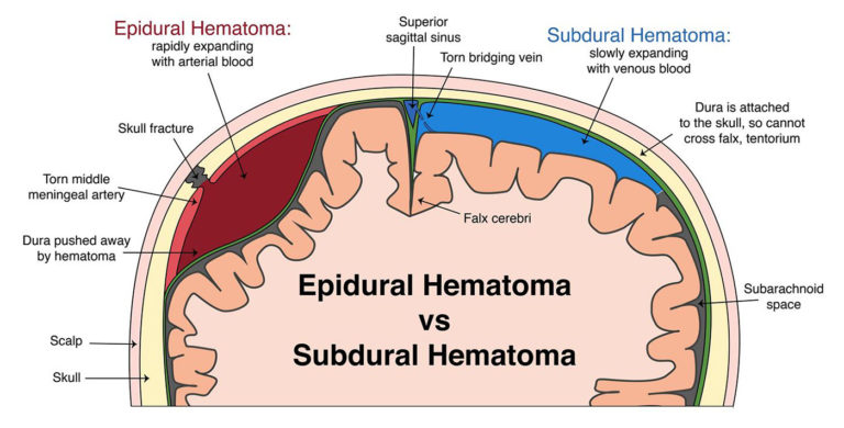 Epidural Hematoma | Epidural Hematoma Clinical Presentation