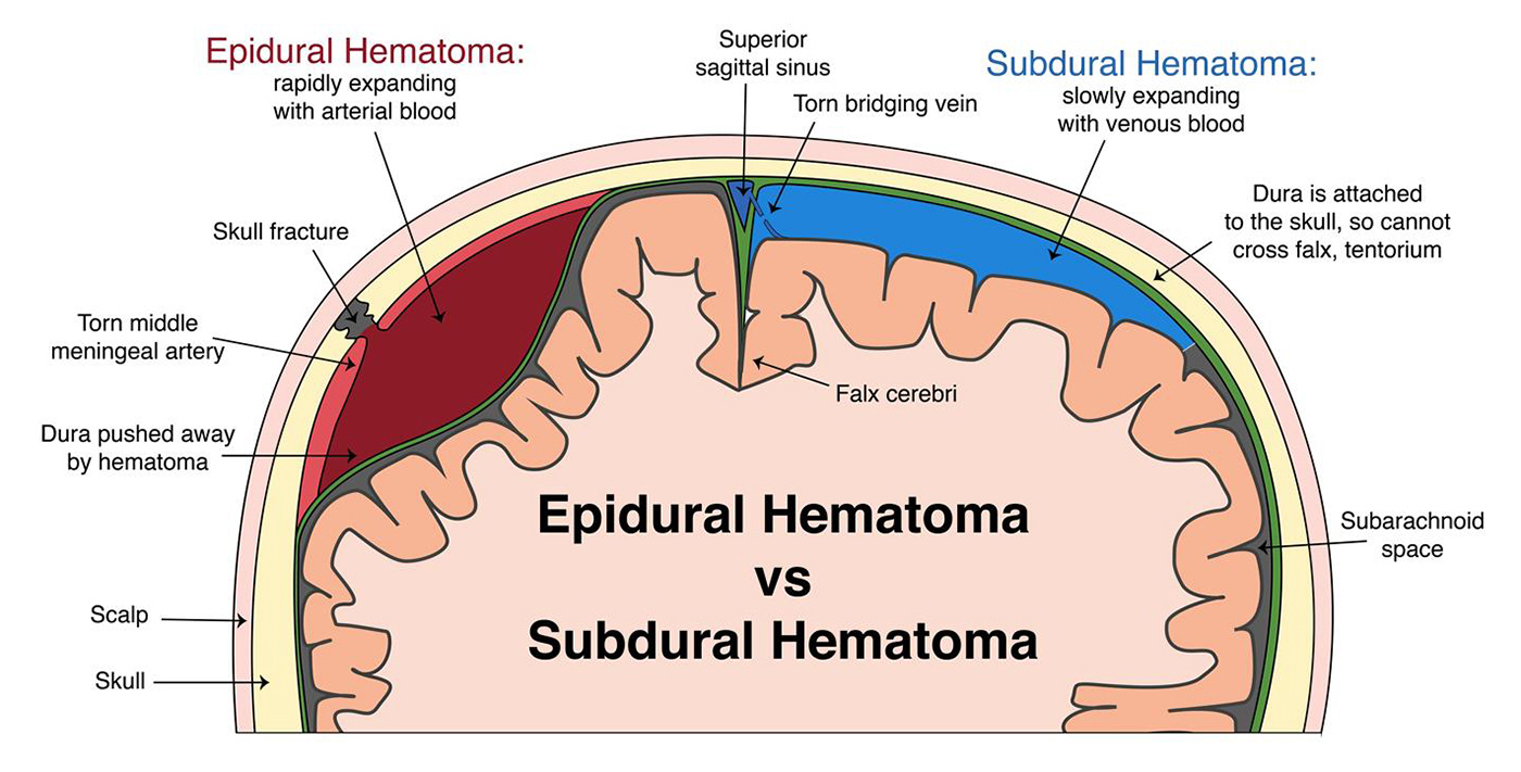 Epidural Hematoma Epidural Hematoma Clinical Presentation Epidural Hematoma Epidural Hematoma Clinical Presentation