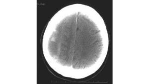 Subdural Hematoma | Top Neuro Docs