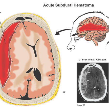 Myocardial Infarction (Heart Attack) | Top Neuro Docs
