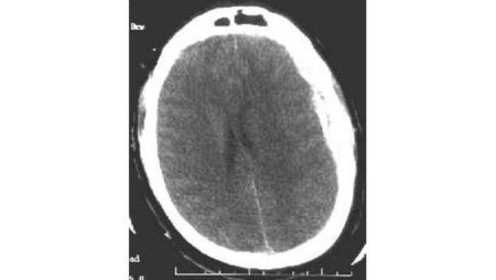 Subdural Hematoma | Top Neuro Docs