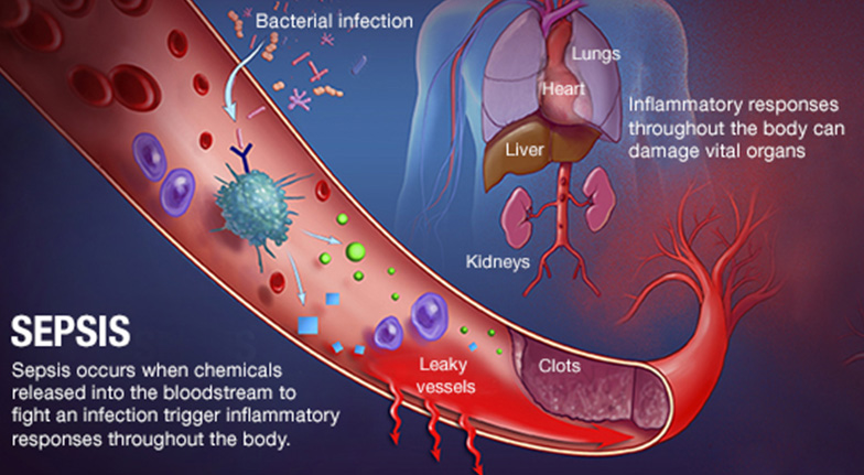 Sepsis Blood Infection
